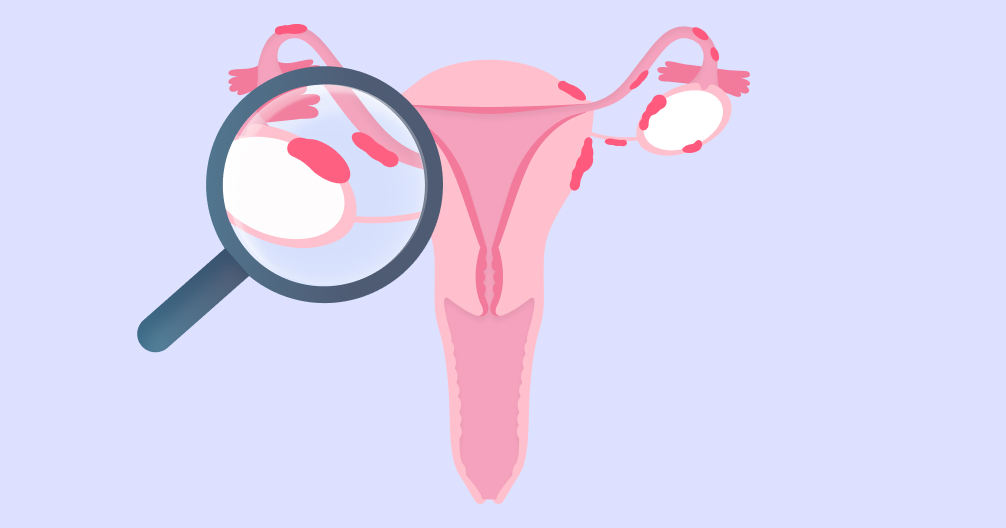 Endometriosis What Causes It How Its Diagnosed And Treated Flo